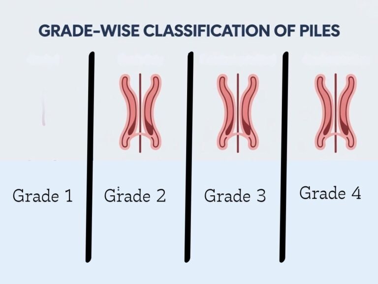 Best Piles Specialist Gurgaon—Low-Cost Packages at SarthiCare - Sarthi Care